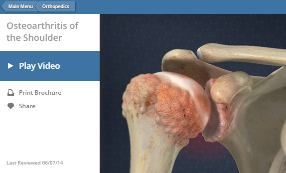 Shoulder Osteoarthritis | Manhattan Orthopedic Care